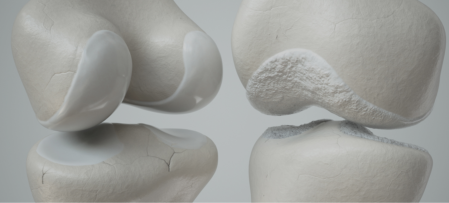 Cartilage Restoration - Dr. Thomas Hackett